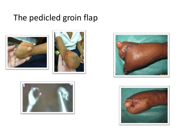 Fessh deformity correction upper limb vr