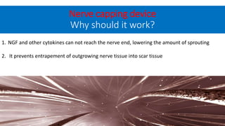 STOP Neuroma, first results of Dutch trial. | PPT