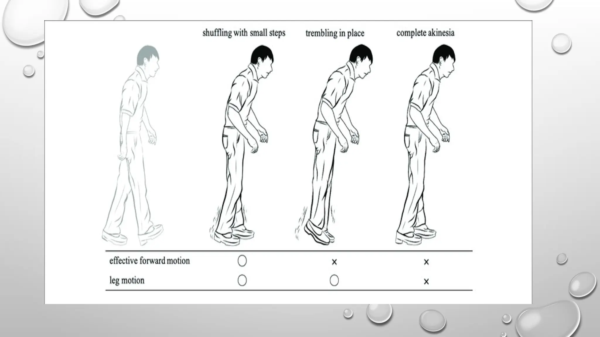 Festinating gait and it's physiotherapy management | PPTX | Physical Therapy | Wellness
