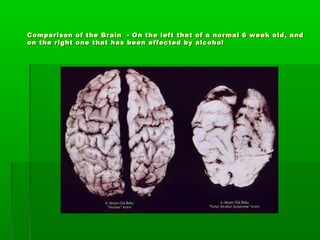 FASD Fetal Alcohol-Spectrum-Disorder | PPT