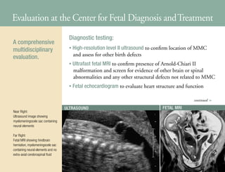 Fetal Surgery for Spina Bifida | PDF
