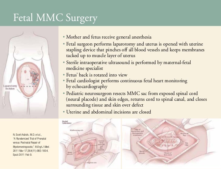 Fetal Surgery for Spina Bifida