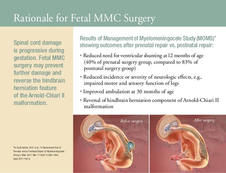 Alan Paul Rumor Fetal Surgery For Myelomeningocele Chop