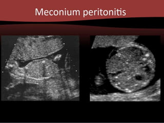 Fetal abdomen usg | PPTX
