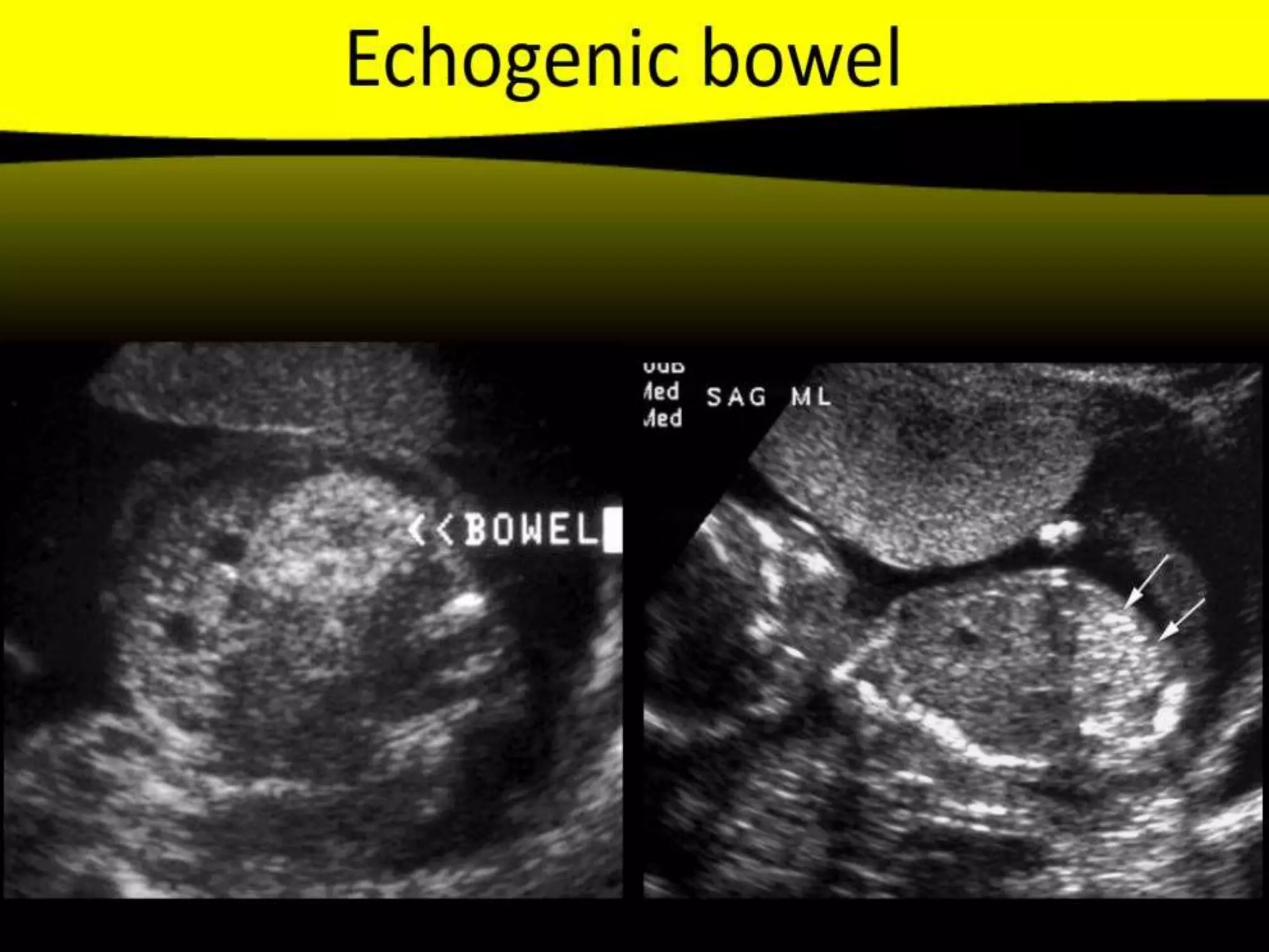 Fetal abdomen usg | PPTX