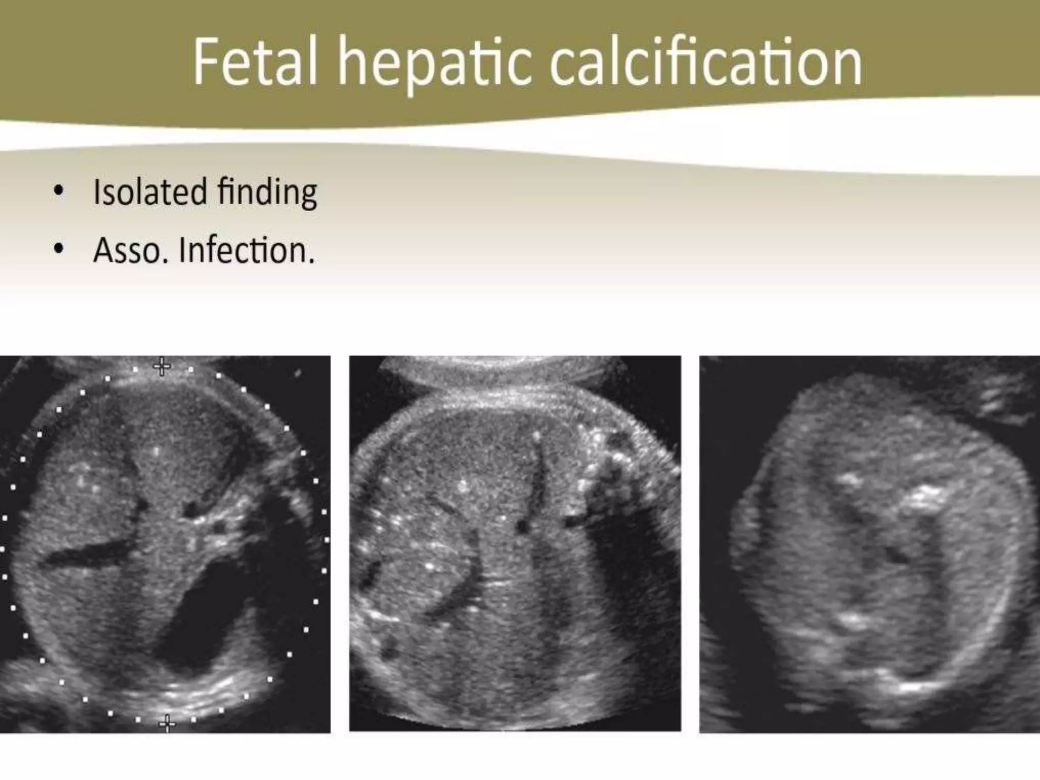 Fetal abdomen usg | PPTX