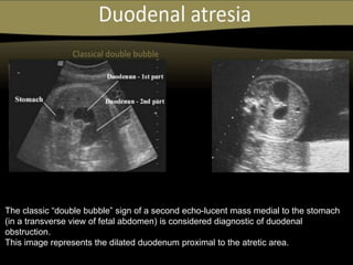 Fetal abdomen usg | PPTX