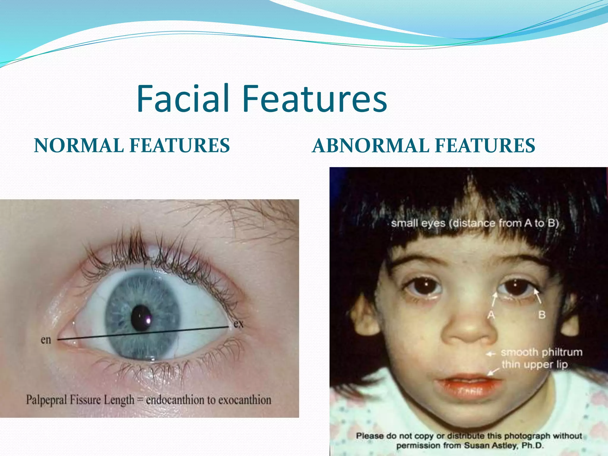 Fetal alcohol syndrome | PPTX