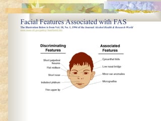 Fetal Alcohol Syndrome fetal alcohol syndrome and fetal alcohol ...