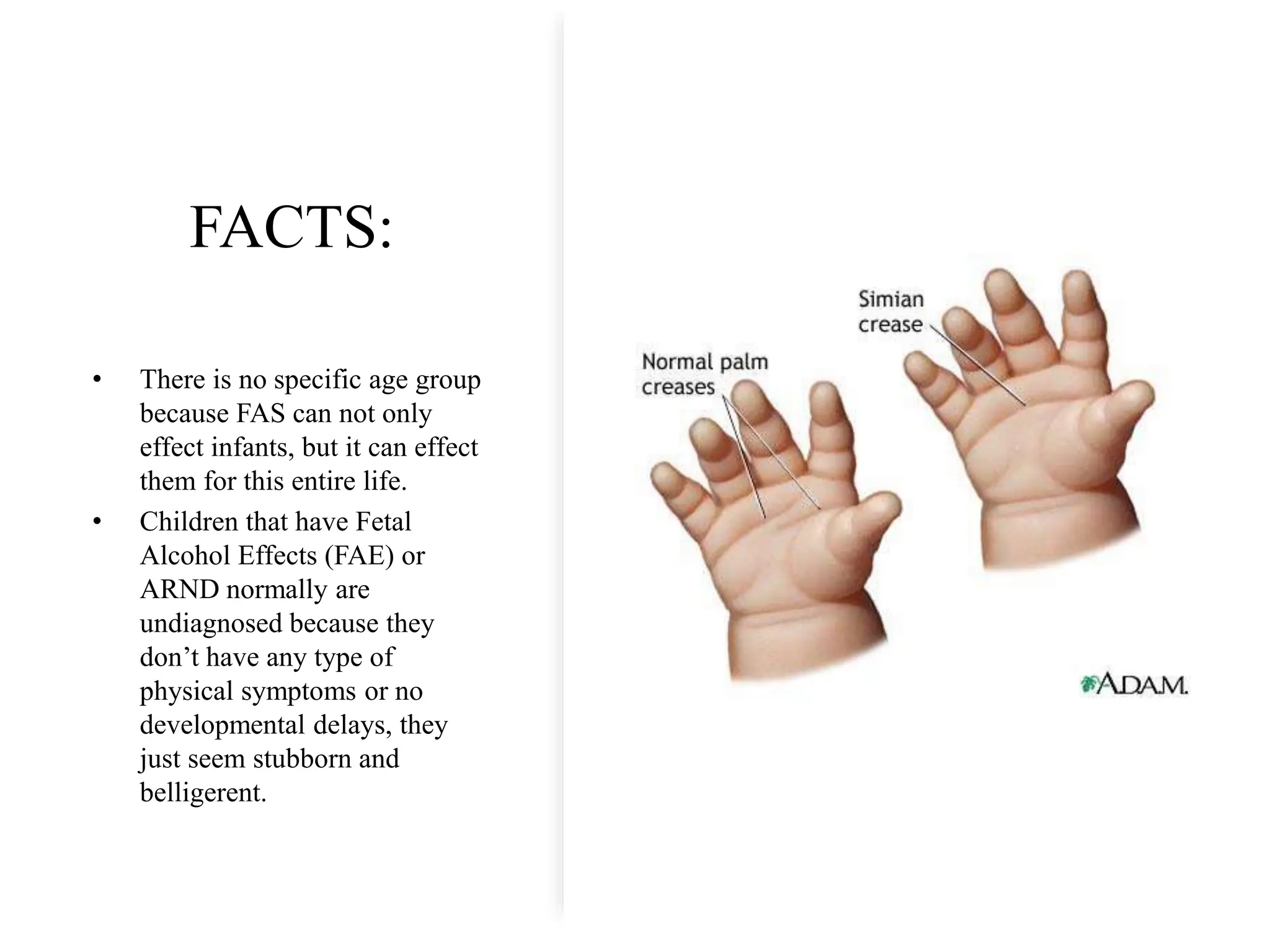Fetal Alcohol Syndrome: How it alcohol affects the brain | PPTX