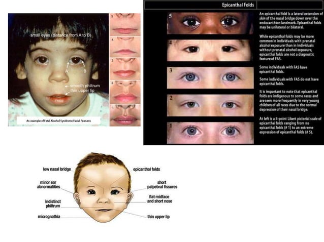 Fetal Alcohol Syndrome: How it alcohol affects the brain | PPTX ...