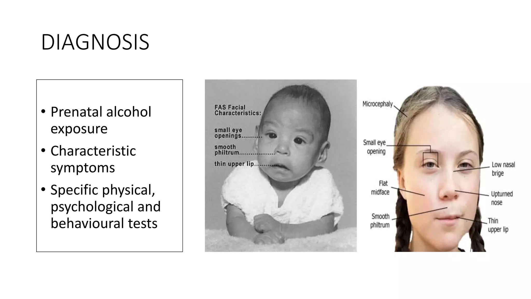 Fetal alcohol syndrome PPT.pptx