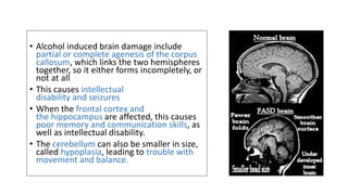 Fetal alcohol syndrome PPT.pptx