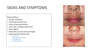 Fetal alcohol syndrome PPT.pptx