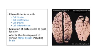 Fetal alcohol syndrome PPT.pptx