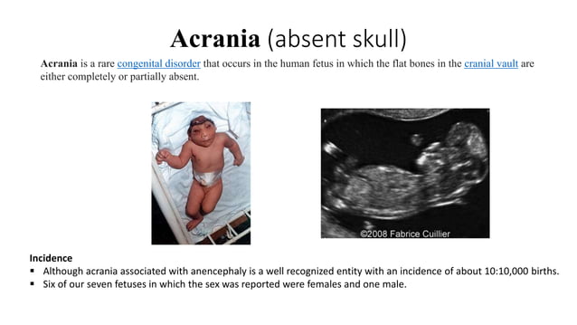 Ultrasound of Fetal anomalies in first trimester | PPTX