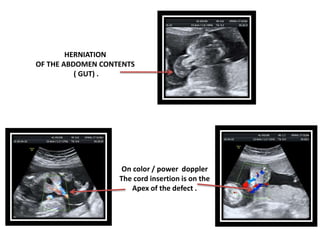 Fetal anomaly archive advanced usg lounge | PPTX