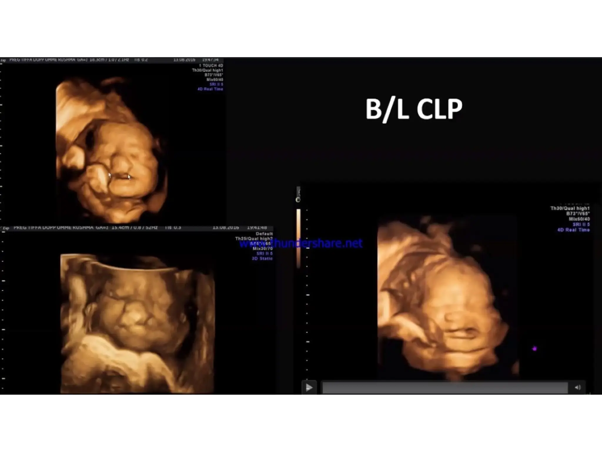 First trimester fetal anomaly scan and beyond part 2 .pptx