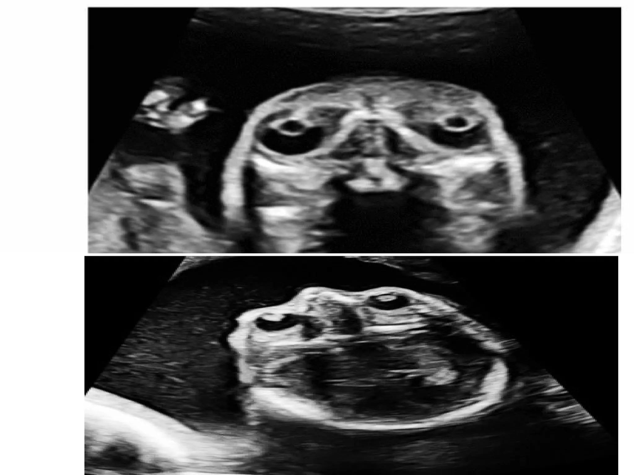 First trimester fetal anomaly scan and beyond part 2 .pptx