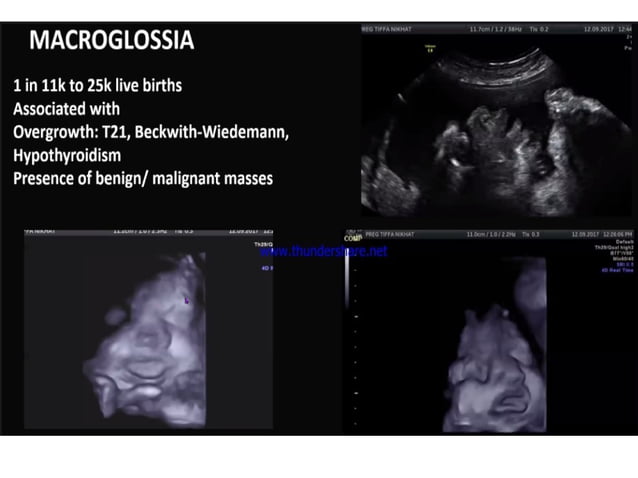 First trimester fetal anomaly scan and beyond part 2 .pptx