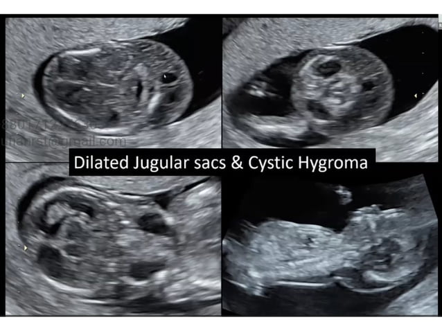 First trimester fetal anomaly scan and beyond part 2 .pptx