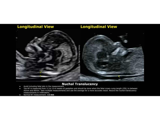 First trimester fetal anomaly scan and beyond part 2 .pptx