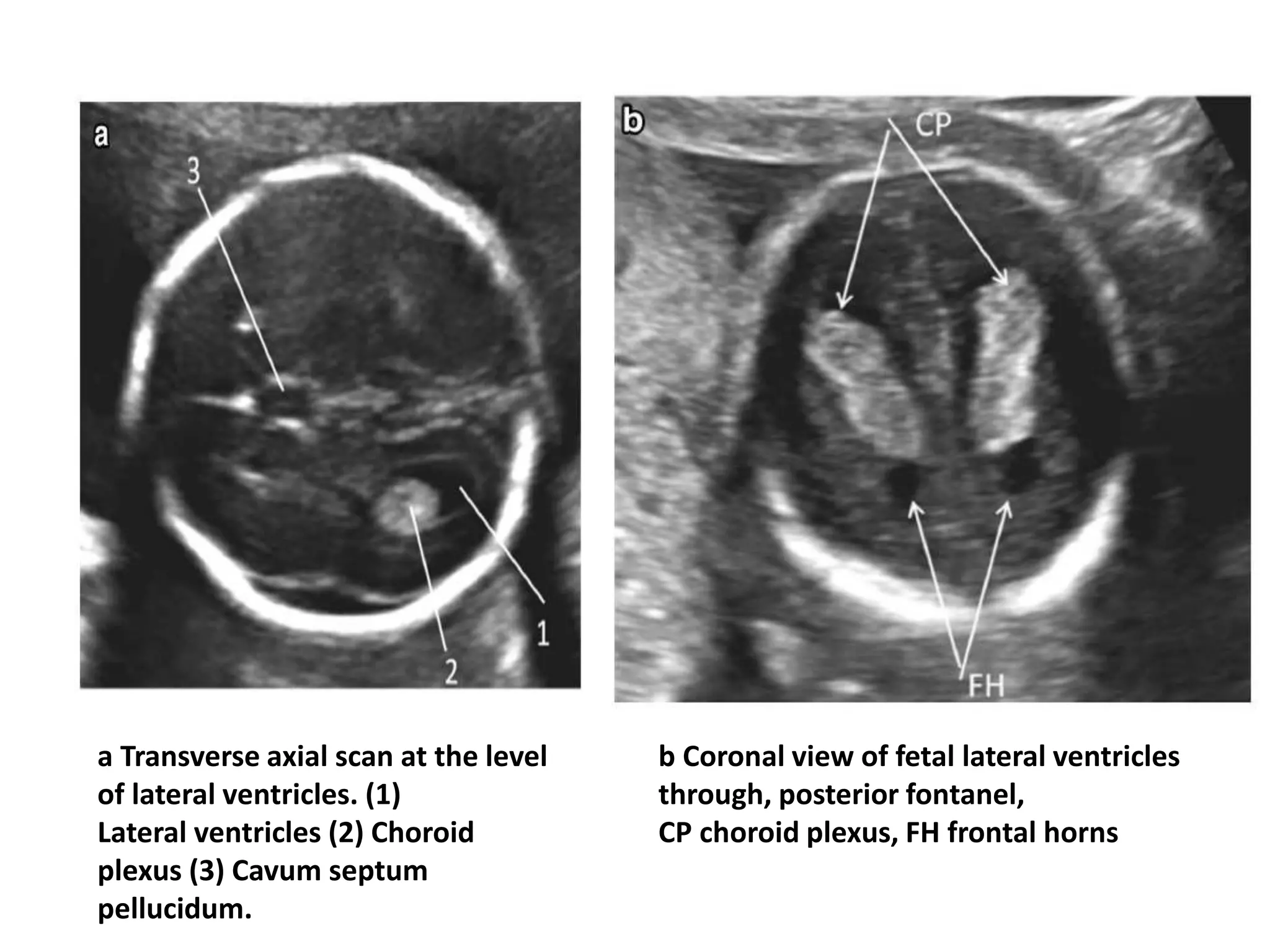 Fetal anomaly scan | PPTX | Pregnancy | Reproductive Health