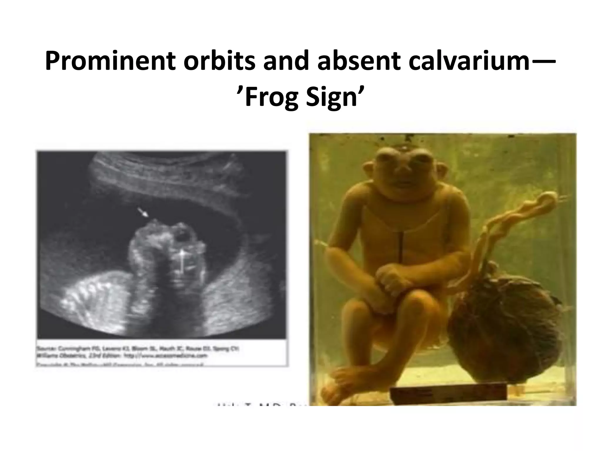 Fetal anomaly scan | PPTX | Pregnancy | Reproductive Health