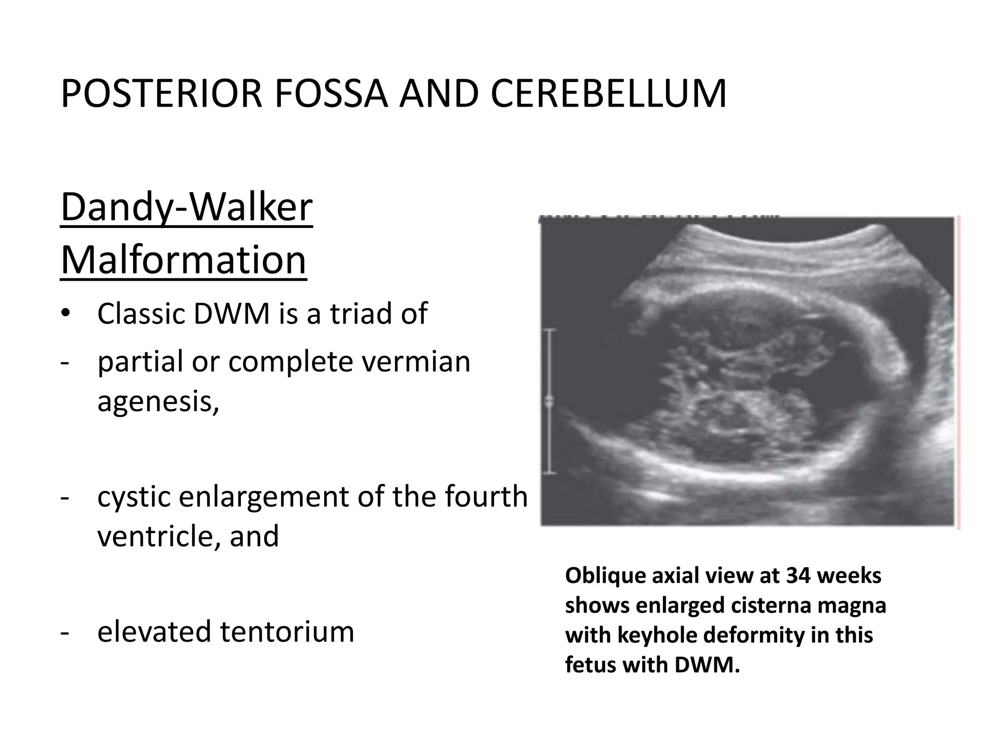 Fetal anomaly scan | PPTX