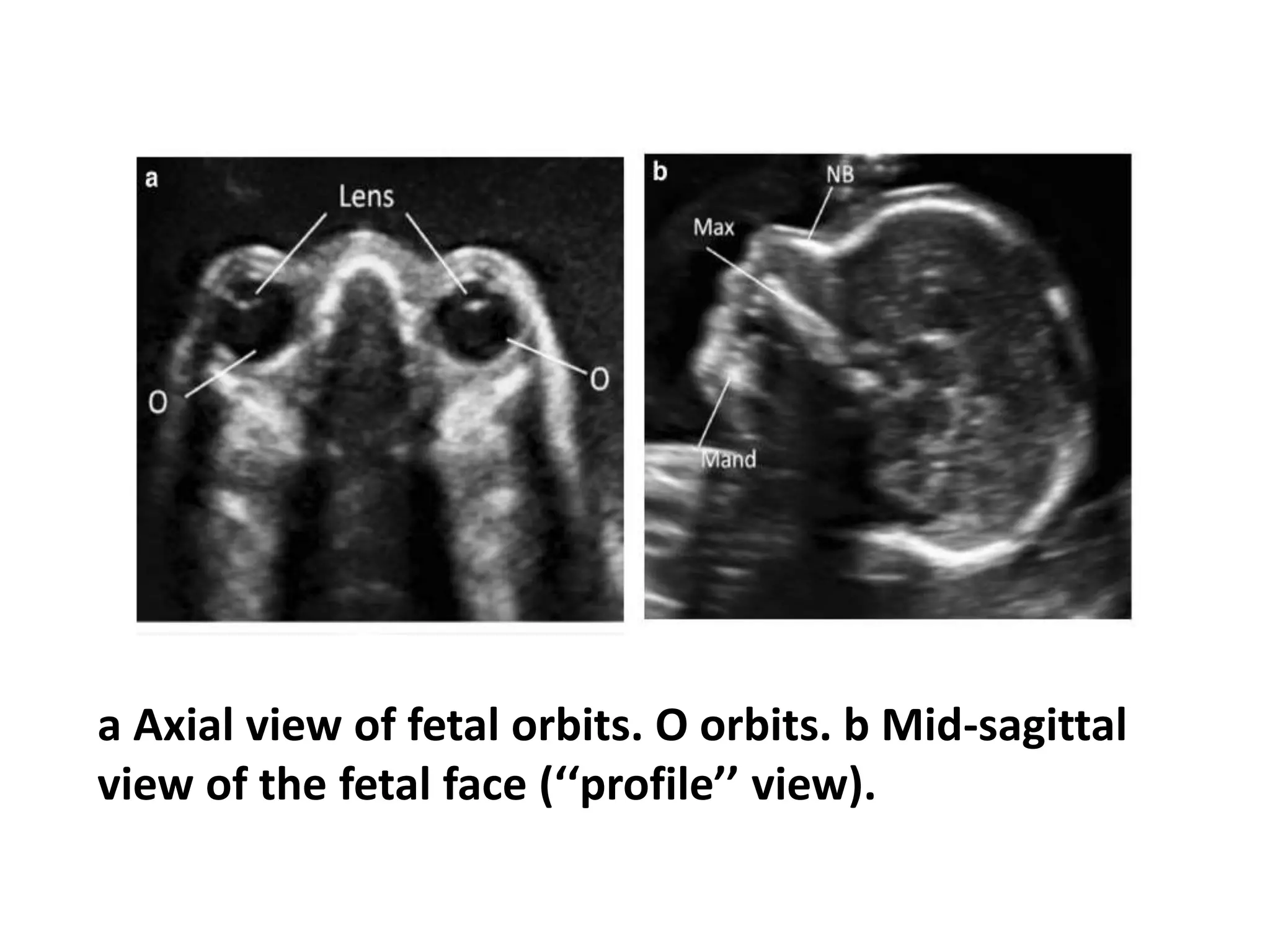 Fetal anomaly scan | PPTX