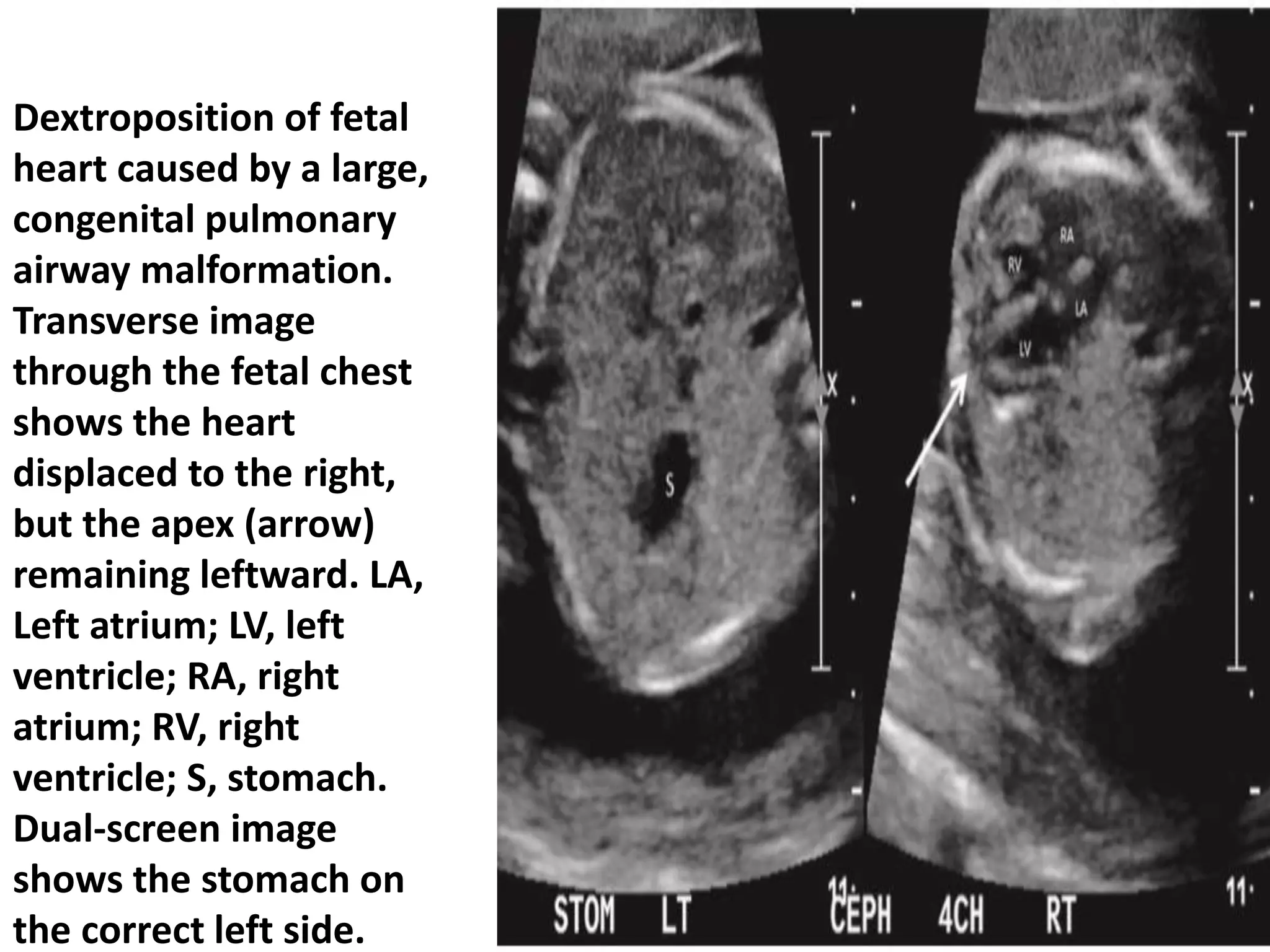 Fetal anomaly scan | PPTX