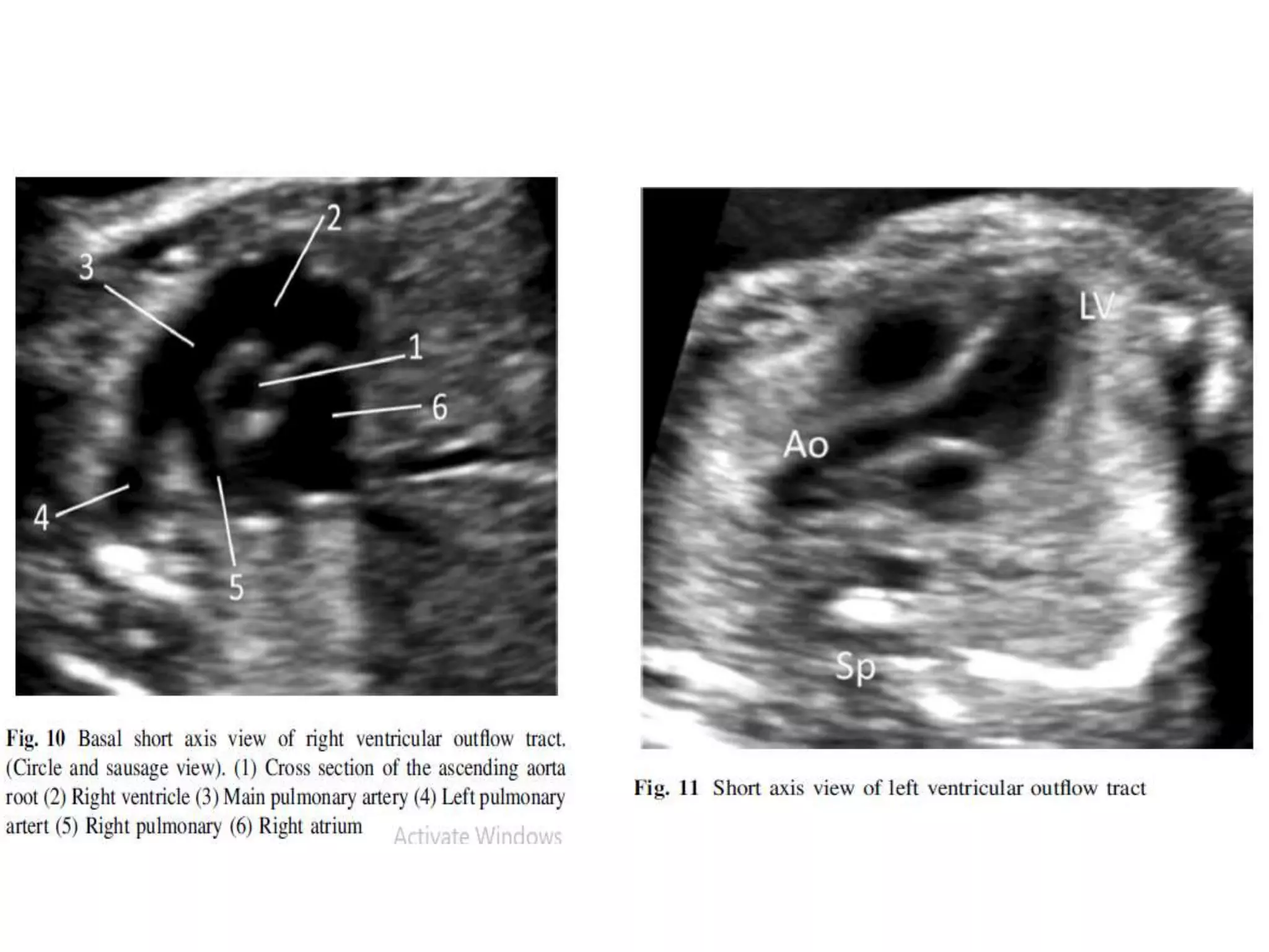Fetal anomaly scan | PPTX