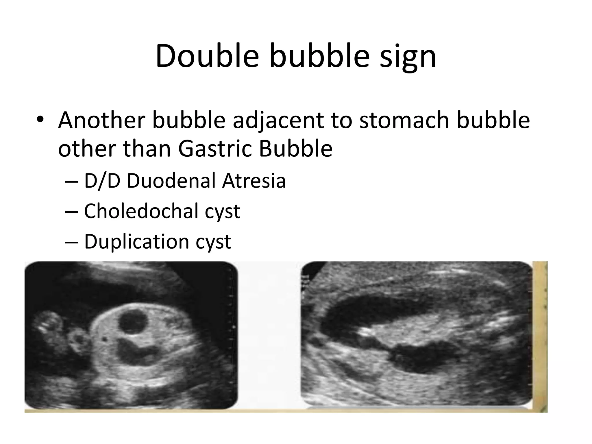 Fetal anomaly scan | PPTX
