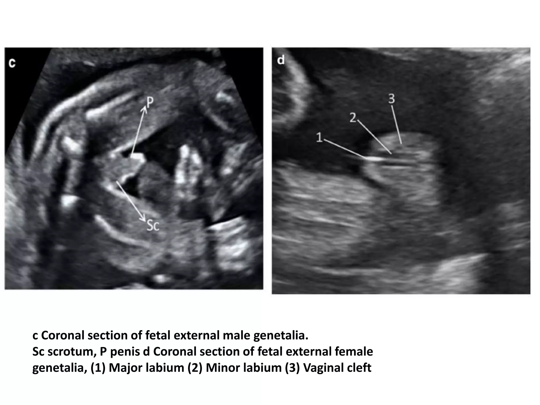 Fetal anomaly scan | PPTX