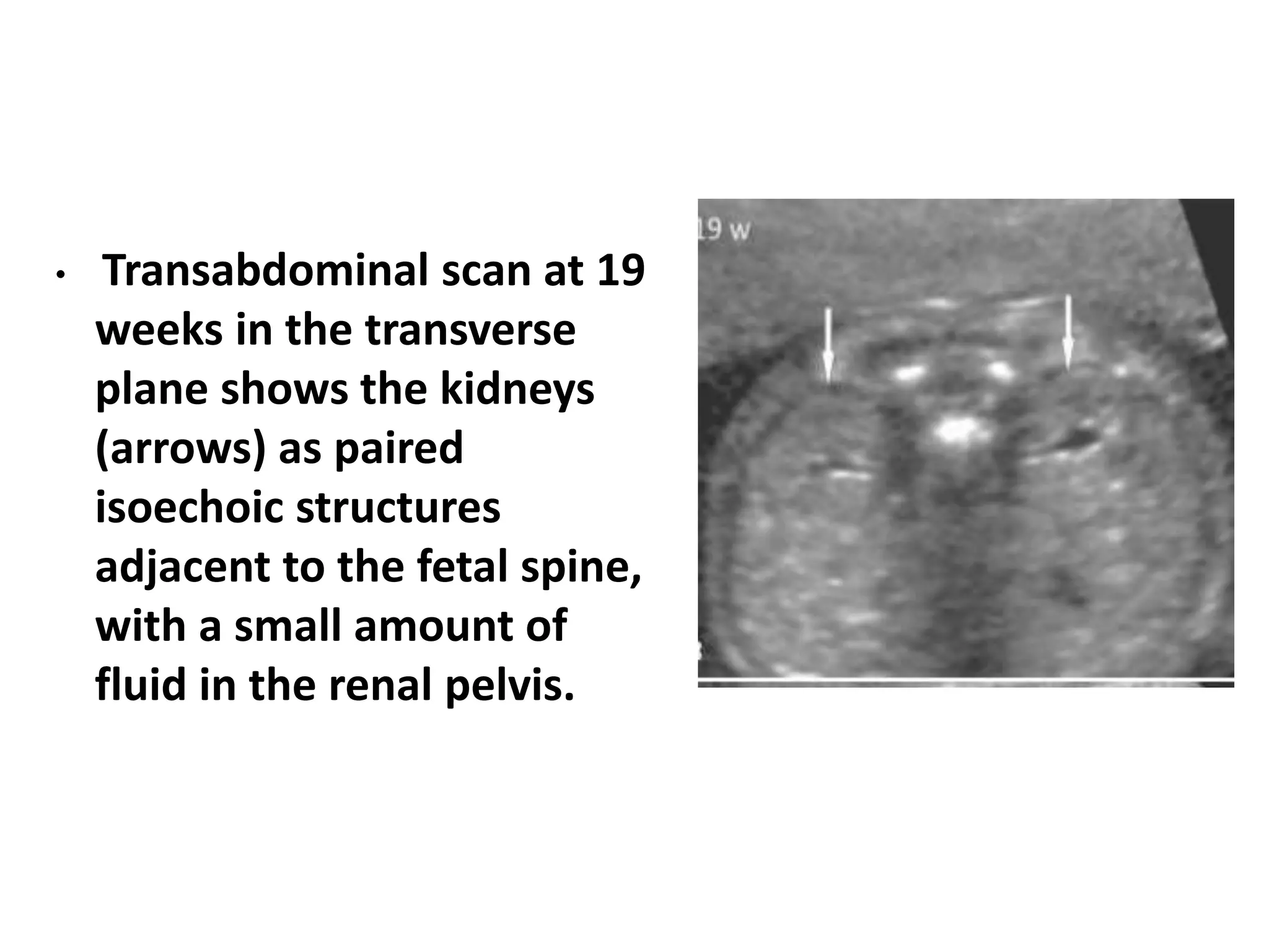 Fetal anomaly scan | PPTX