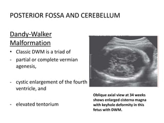 Fetal anomaly scan | PPTX