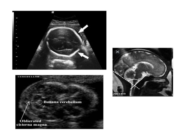 Fetal anomaly scan | PPTX | Pregnancy | Reproductive Health