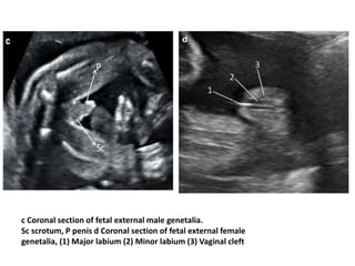 Fetal anomaly scan | PPTX
