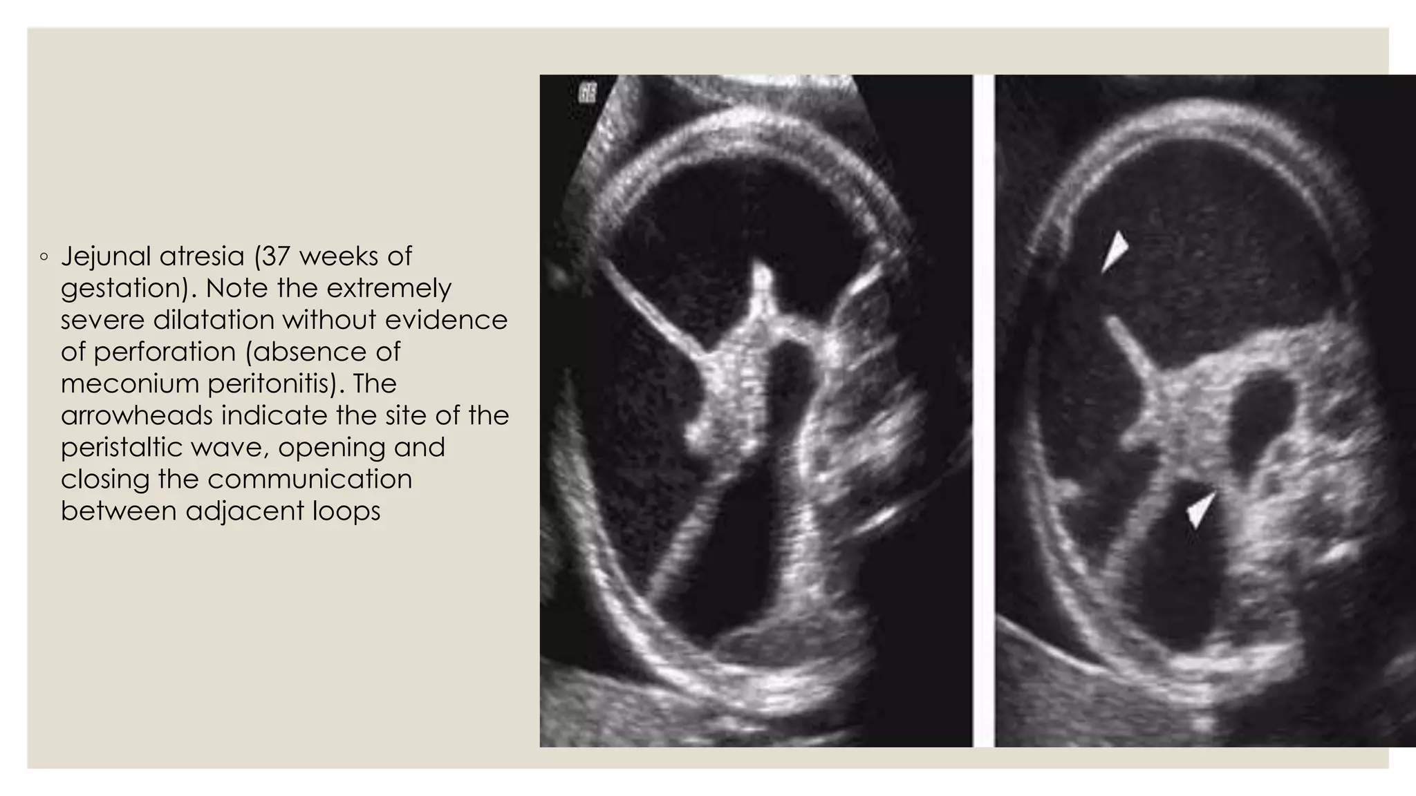 Fetal anomaly scan pt2 | PPTX