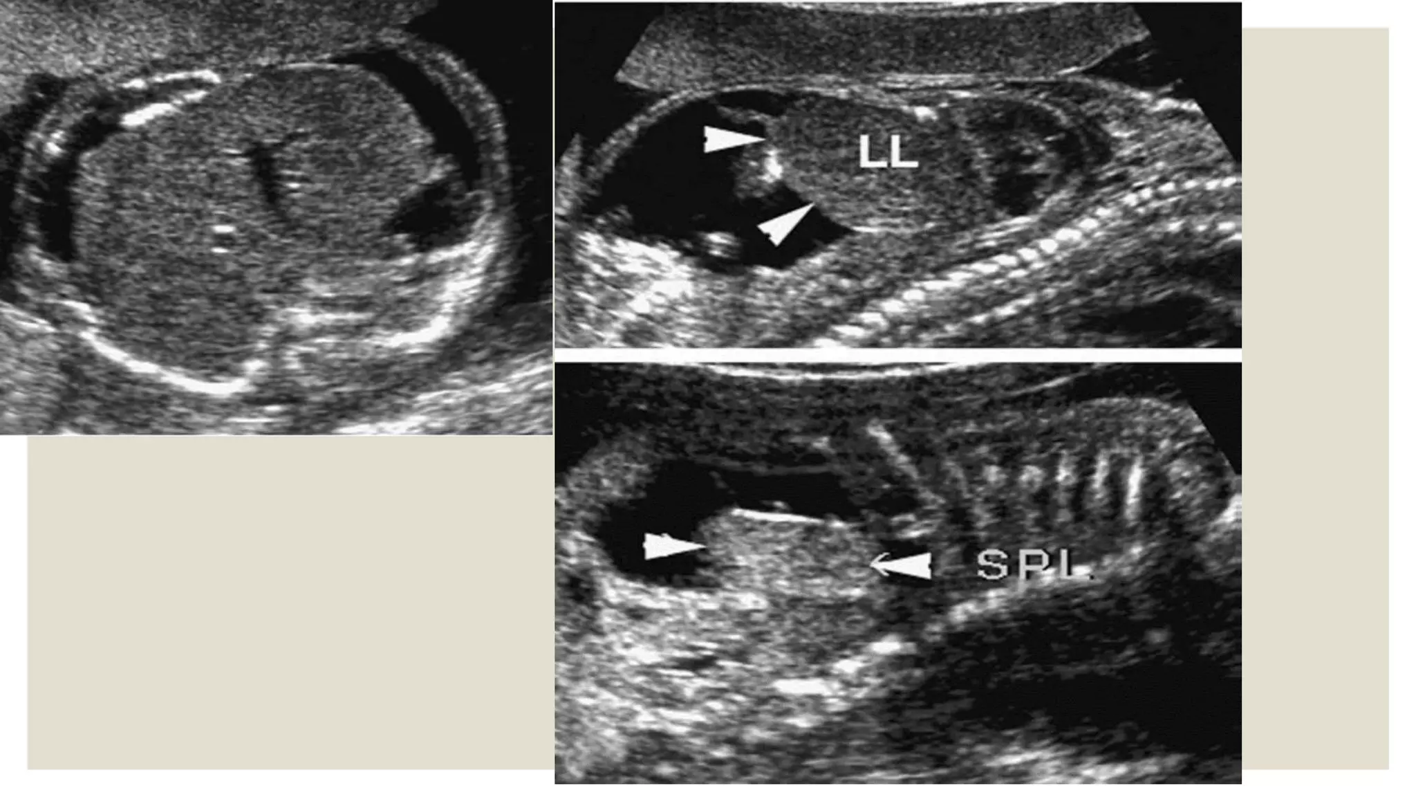 Fetal anomaly scan pt2 | PPTX | Pregnancy | Reproductive Health
