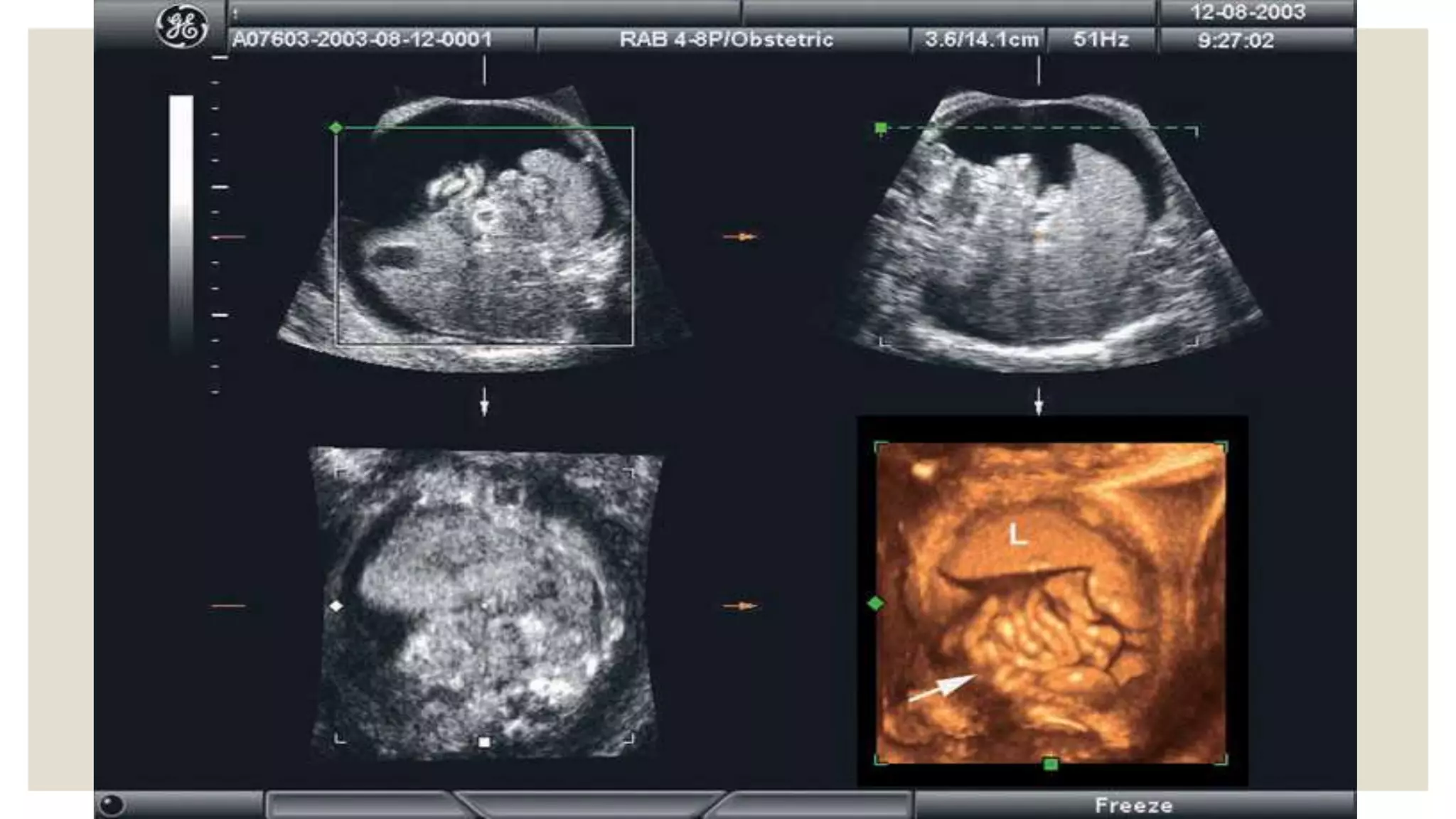Fetal anomaly scan pt2 | PPTX | Pregnancy | Reproductive Health