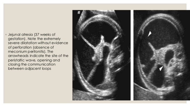 What Is A Us Obstetric Foetal Anatomy Scan