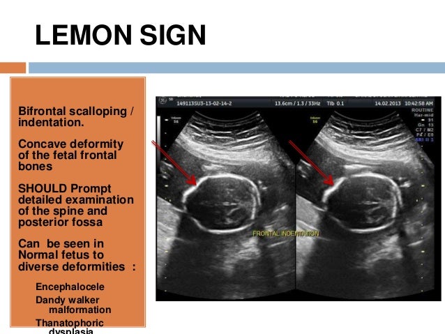 Fetal anomaly series cranial features of spina bifida