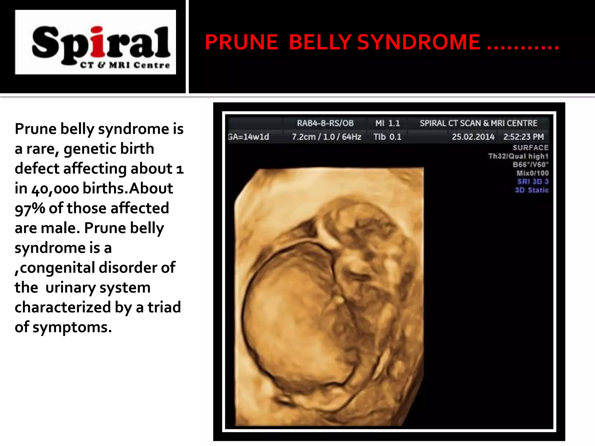 Fetal anomaly series prune belly syndrome. | PPTX