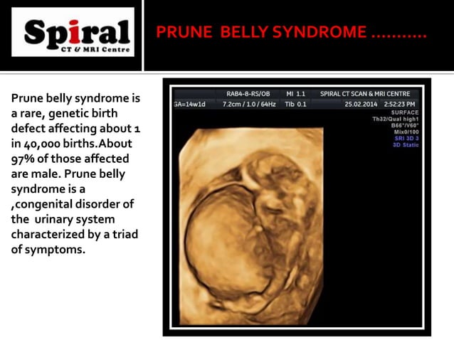 Fetal anomaly series prune belly syndrome. | PPT