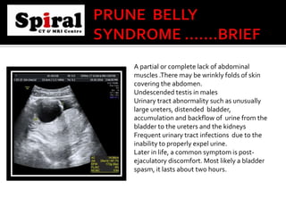 Prune Belly Syndrome Ultrasound