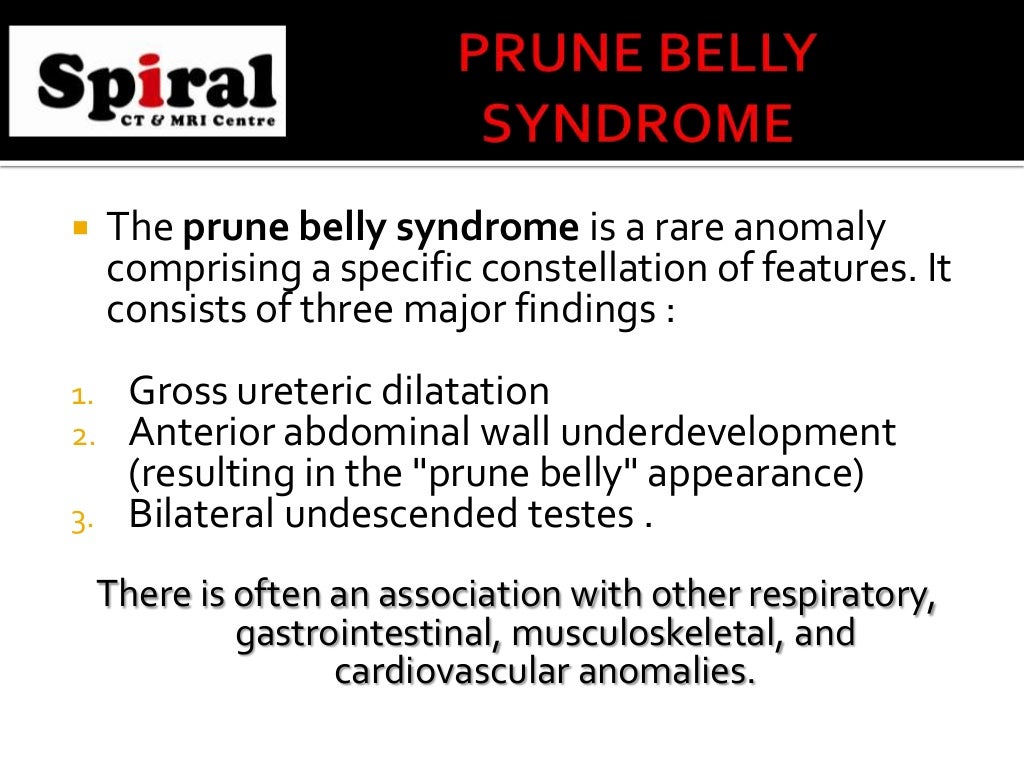 Fetal Anomaly Series Prune Belly Syndrome