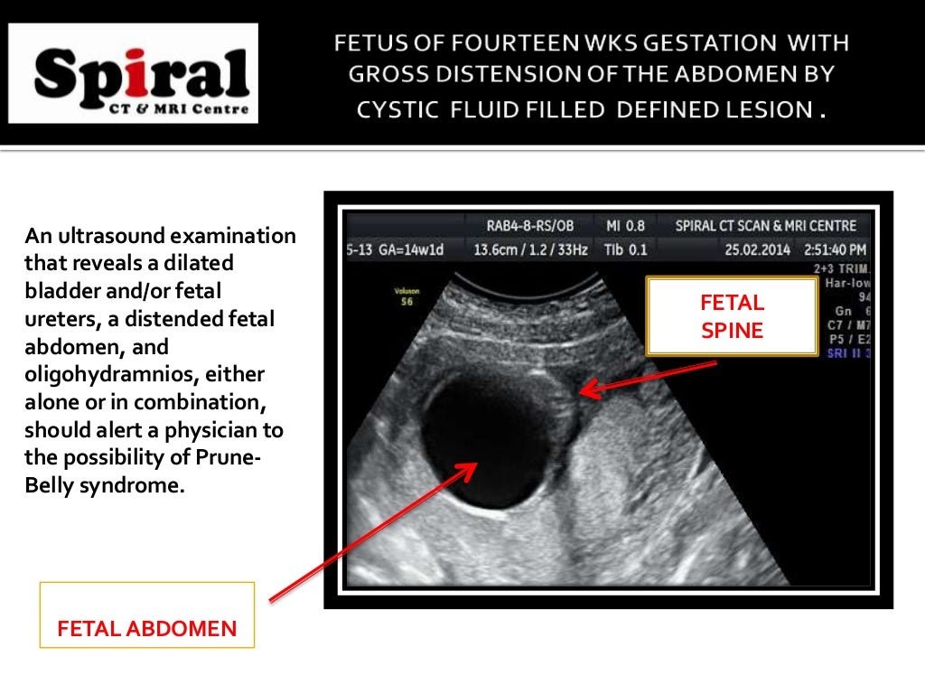 Fetal anomaly series prune belly syndrome.