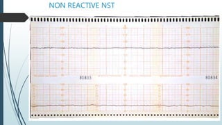 antenatal assessment of Fetal wellbeing | PPTX