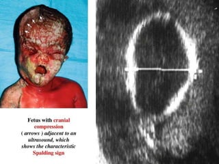 Fetal autopsy | PPTX